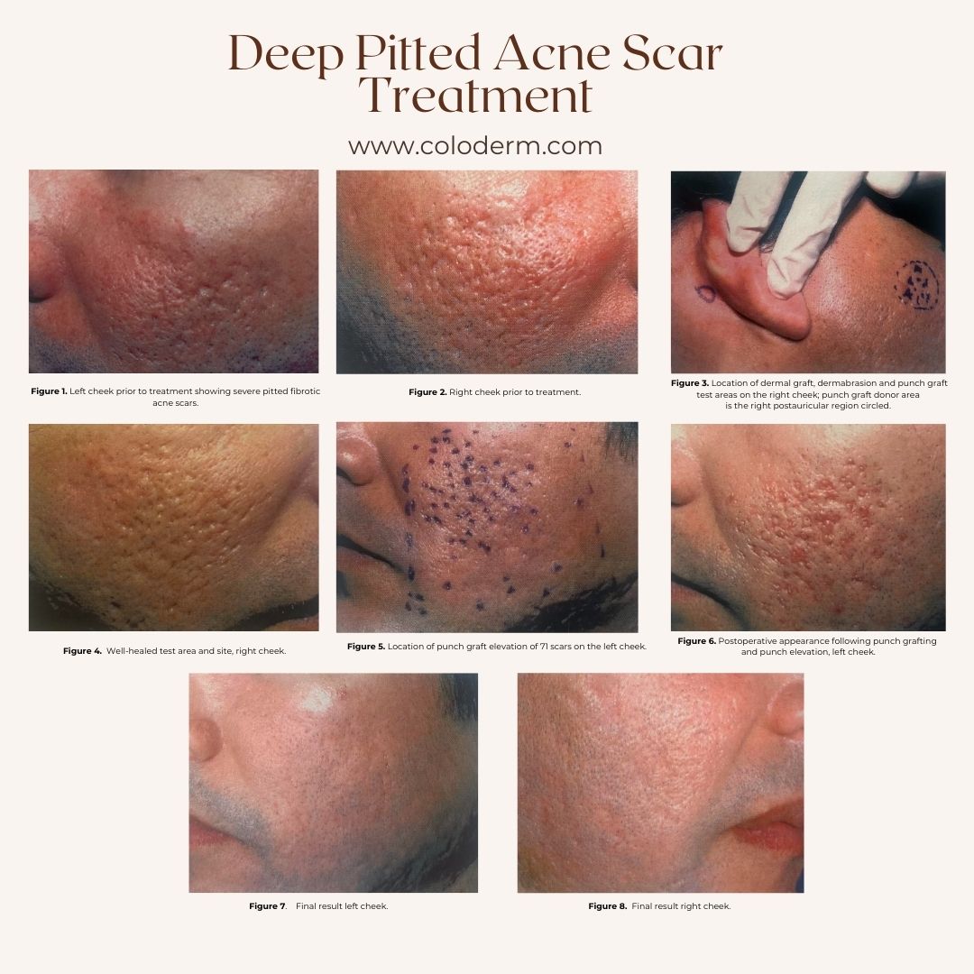 Treatment Of Deep Pitted Acne Scars Colorado Dermatology Center Blog Treatment Of Deep Pitted Acne Scars Colorado Dermatology Center Blog